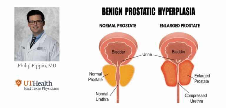 Men's Health Month: Benign Prostatic Hyperplasia - UT Health East Texas